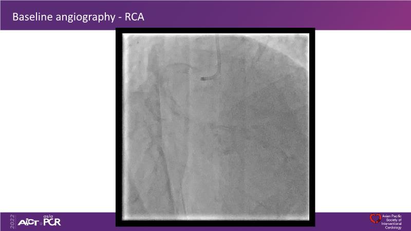 Beginning with the end in mind - FFR vs. IVUS imaging