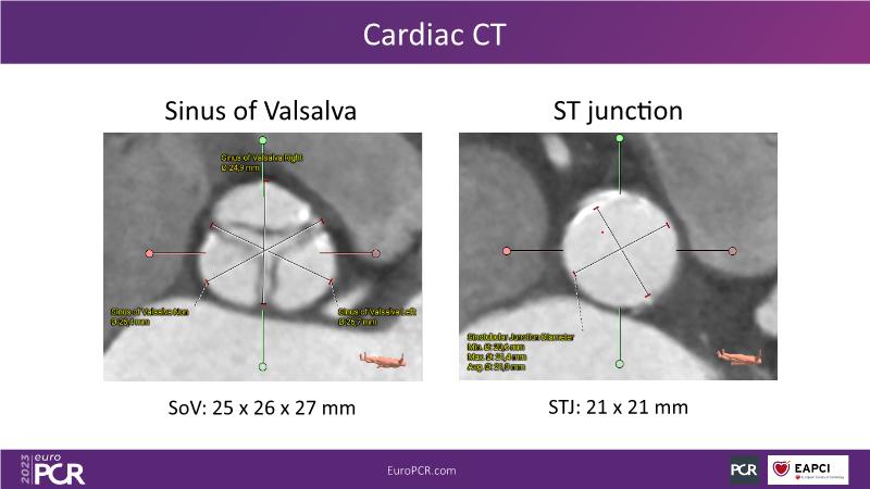 Contemporary best clinical practice for TAVI