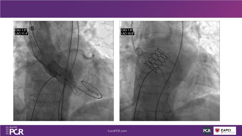 Next generation balloon expandable TAVR and thin strut BRS - Science and clinical update