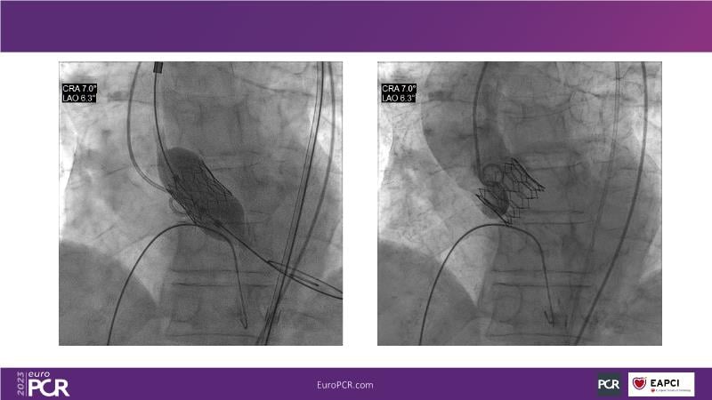 Next generation balloon expandable TAVR and thin strut BRS - Science and clinical update