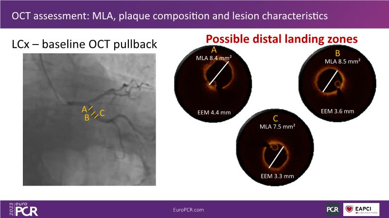 Rethinking PCI in left main: OCT-guided optimisation