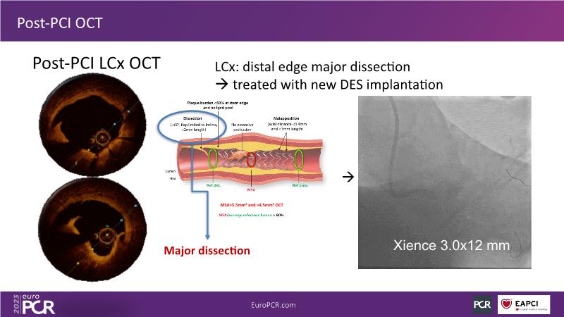 Rethinking PCI in left main: OCT-guided optimisation