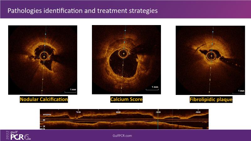 OCT and artificial intelligence: a new shiny light for better decision making in complex ...