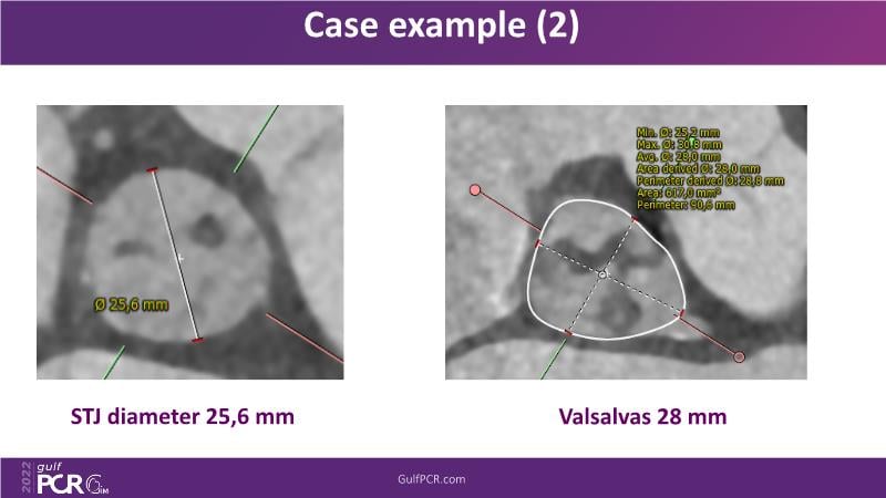Imaging in TAVI with challenging anatomy