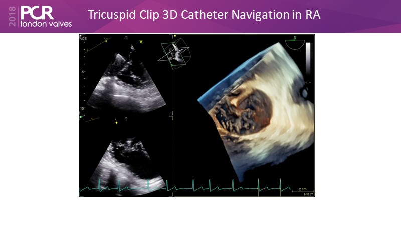 MitraClip NTR and XTR: more options, more possibilities